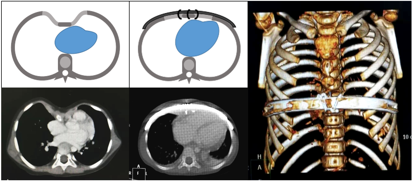 The Wang Procedure: A Safe and Effective Treatment for Pectus Excavatum ...